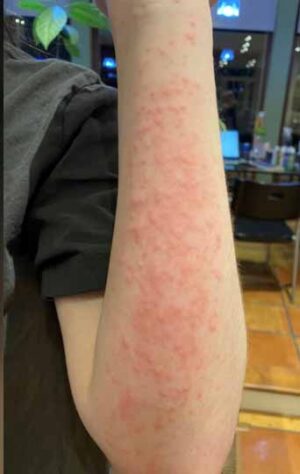 'Allergic' to Cold Temperatures: One Girl's Story of Cold Urticaria ...
