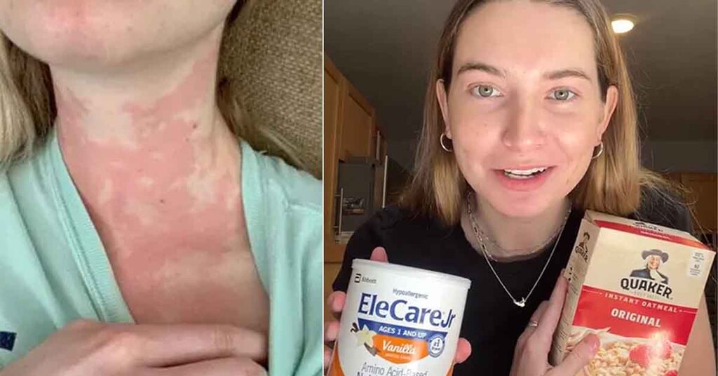 MCAS Limits Woman to Two Foods for Fear of Allergic Reactions ...